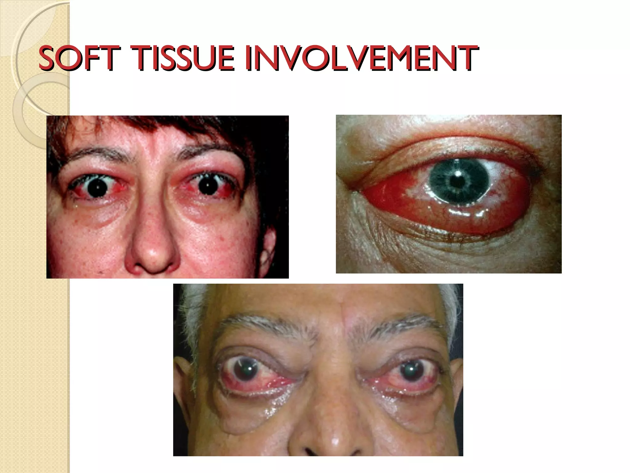 THYROID EYE DISEASE | PPT