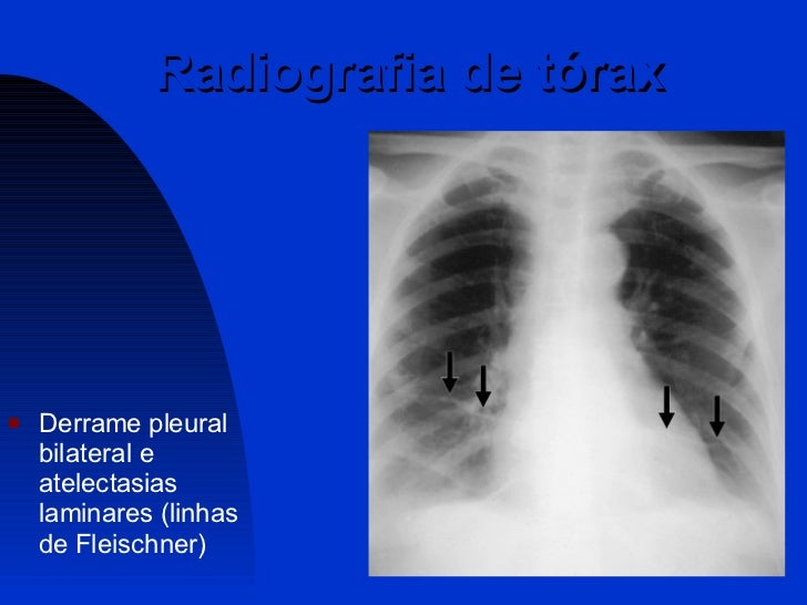 Troboembolia Pulmonar