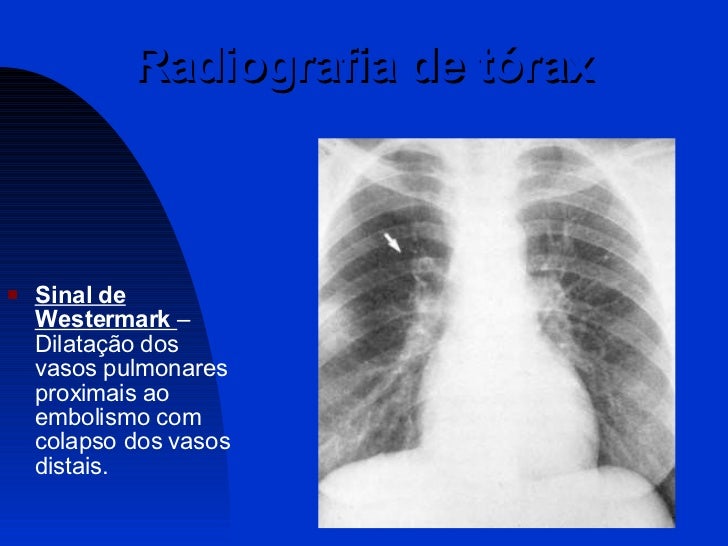 Troboembolia Pulmonar