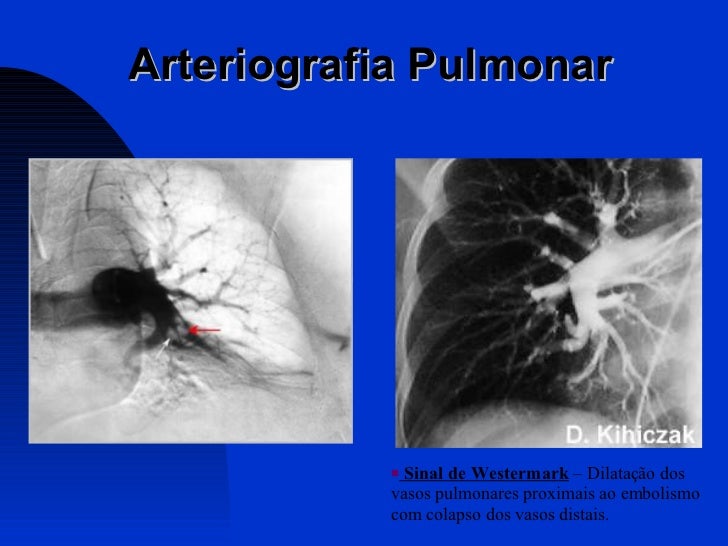 Troboembolia Pulmonar