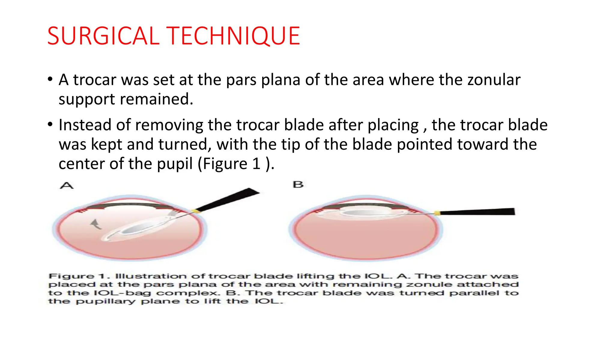TROCAR BLADE-assisted scleral fixation for dislocated iol | PPTX