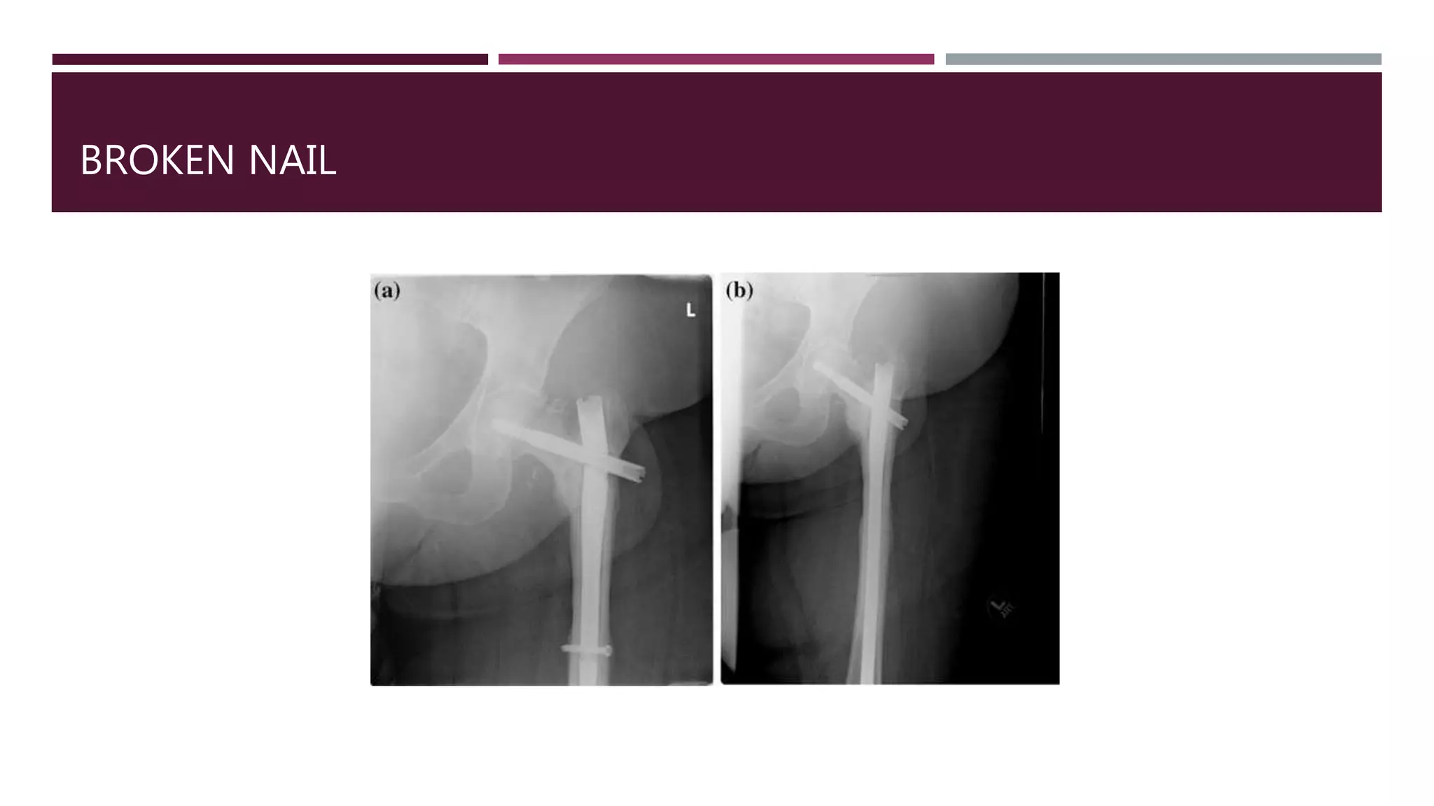 Trochanteric and subtrochanteric non union dr mahmoud hadhoud | PPT