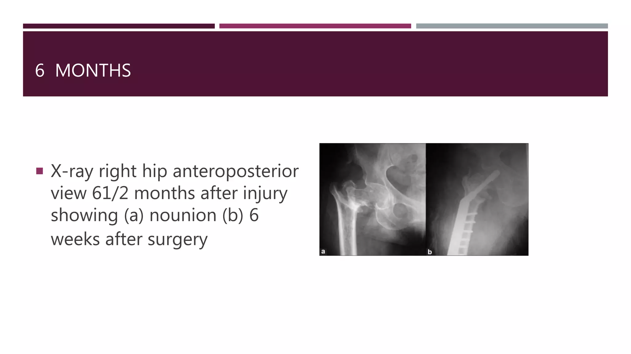 Trochanteric and subtrochanteric non union dr mahmoud hadhoud | PPT