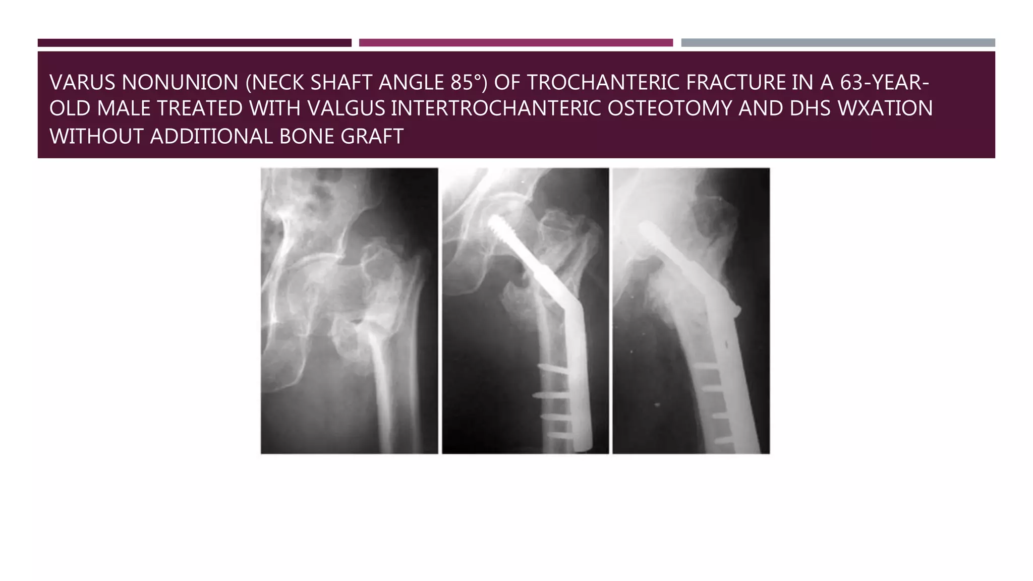 Trochanteric and subtrochanteric non union dr mahmoud hadhoud | PPT