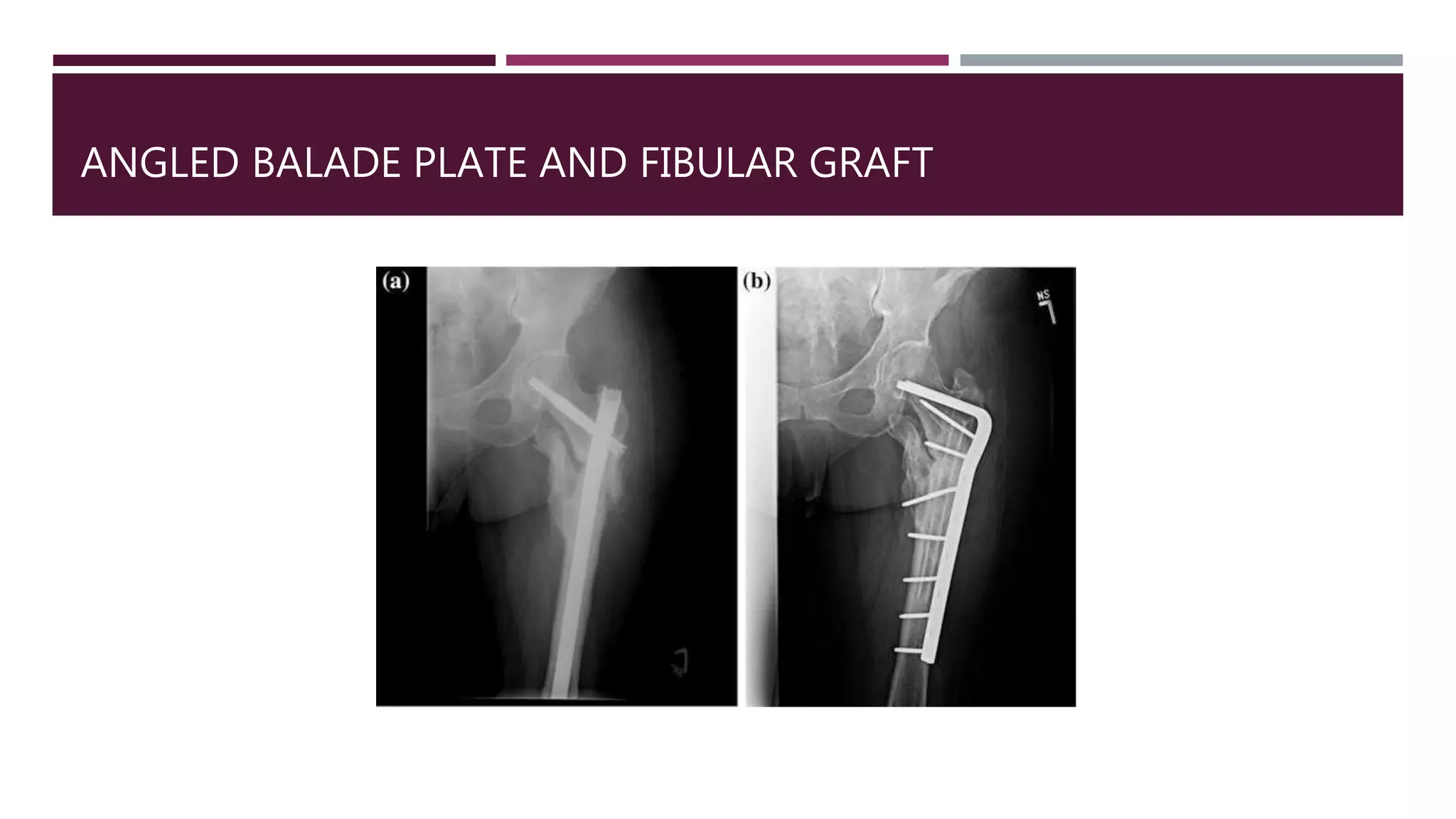 Trochanteric and subtrochanteric non union dr mahmoud hadhoud | PPT