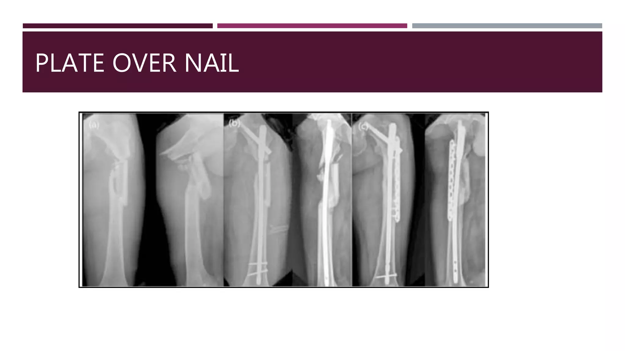 Trochanteric and subtrochanteric non union dr mahmoud hadhoud | PPT