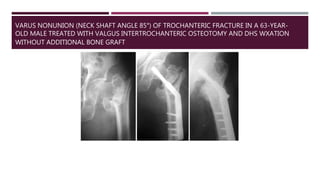 Trochanteric and subtrochanteric non union dr mahmoud hadhoud | PPTX
