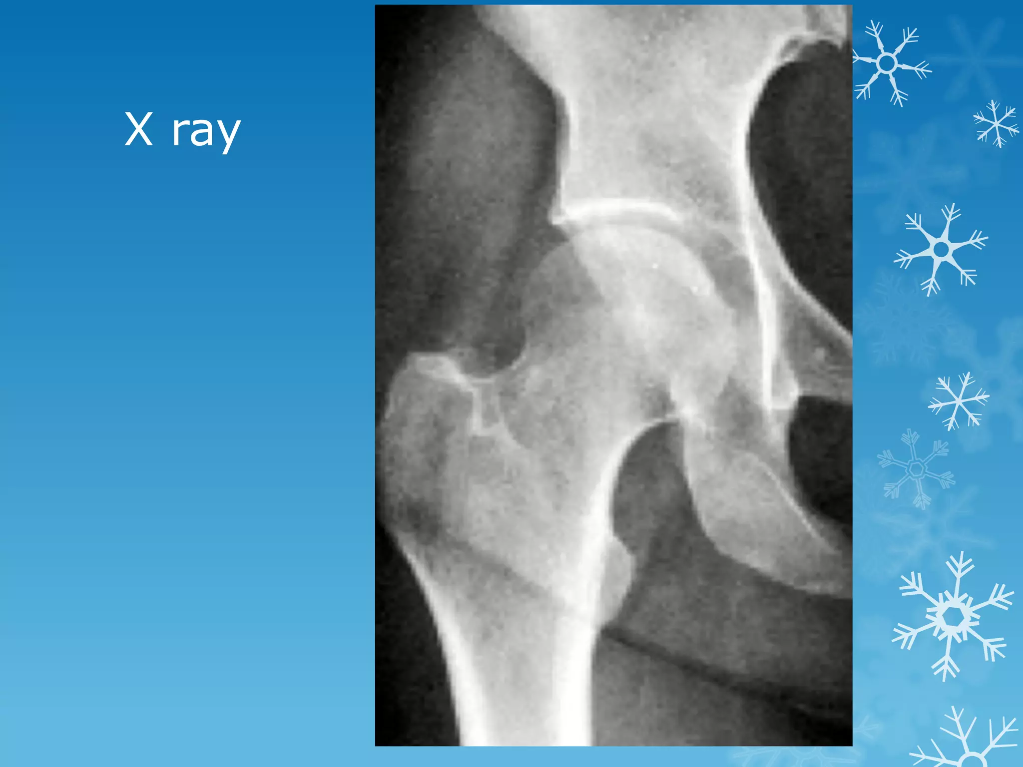 Trochanteric fracture | PPTX