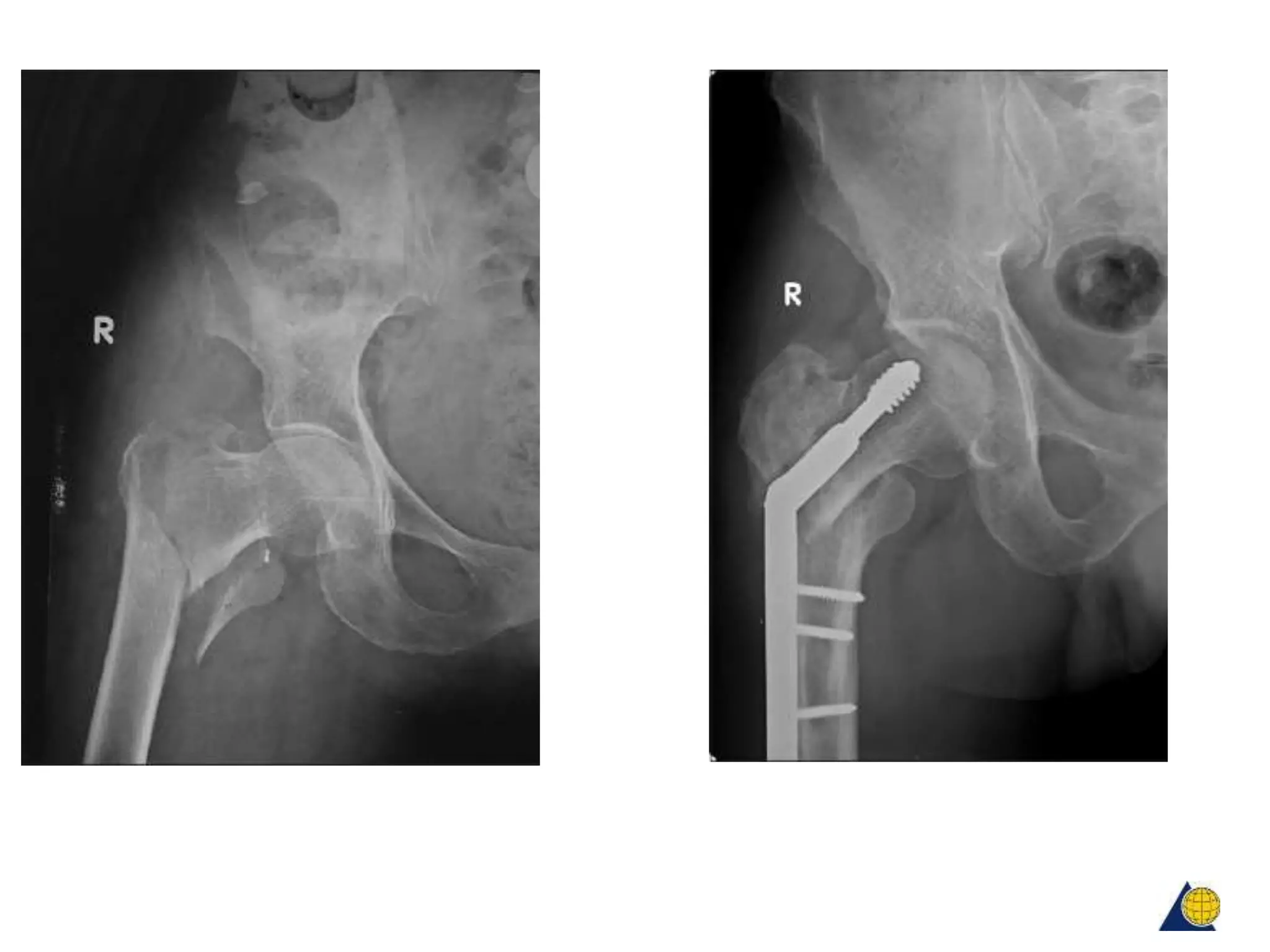 Trochanteric fractures | PPTX