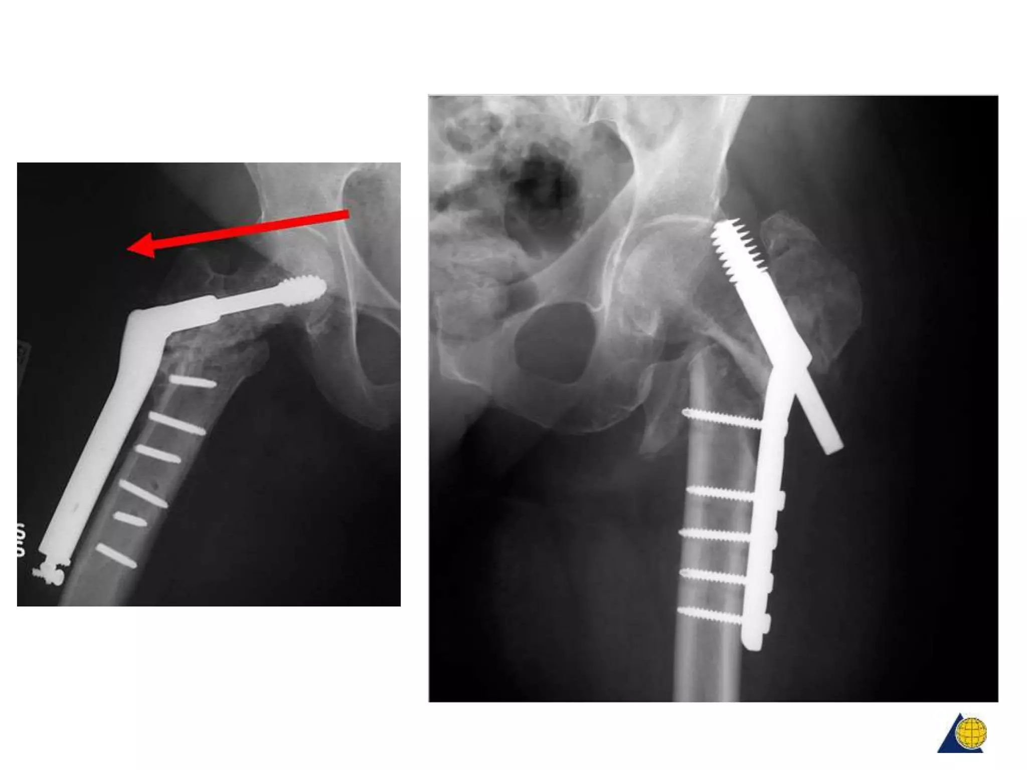 Trochanteric fractures | PPTX