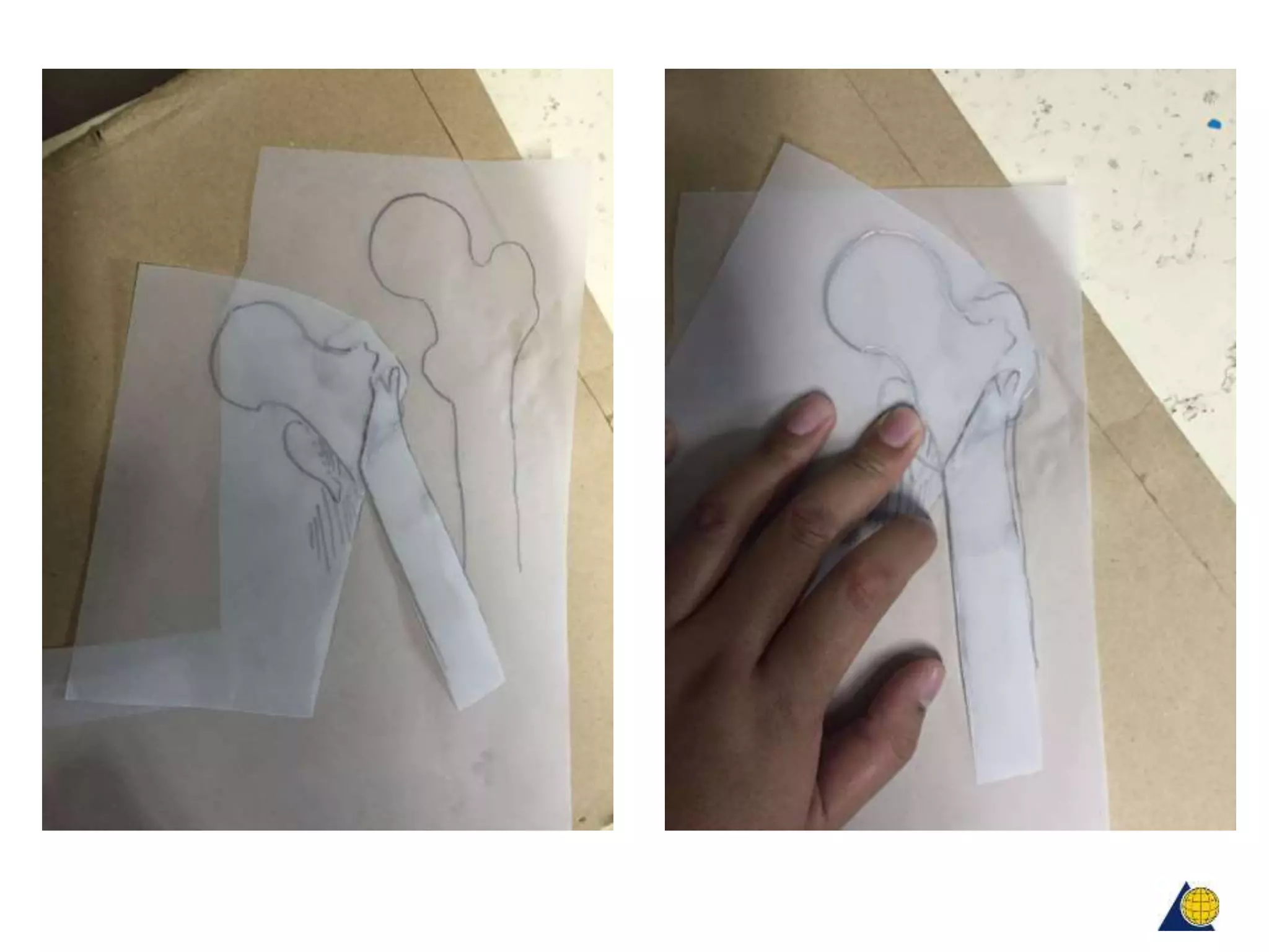 Trochanteric fractures | PPTX