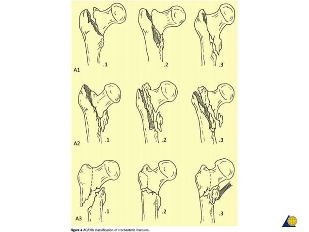 Trochanteric fractures