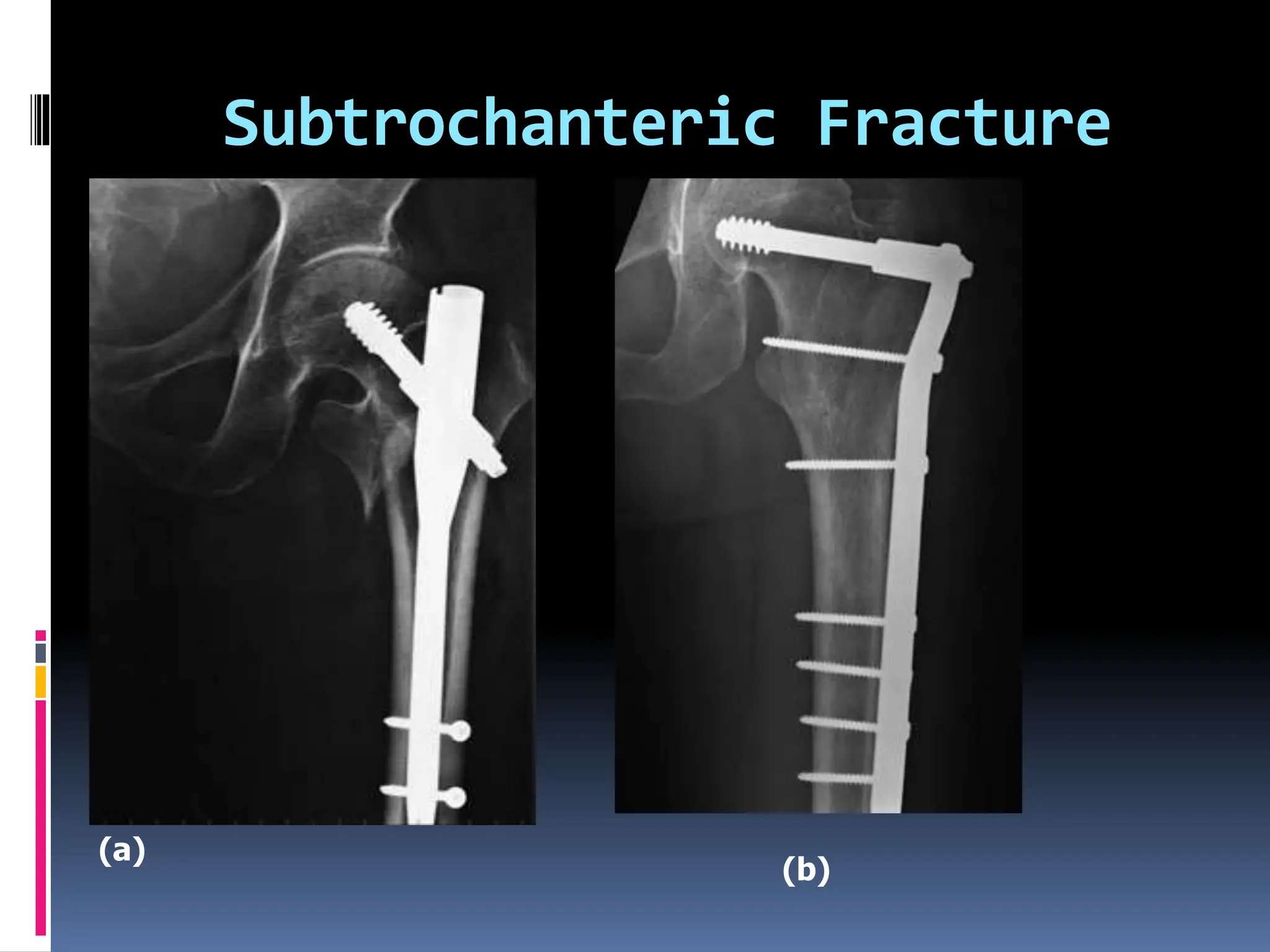 trochanteric fractures.ppt. .. .. | PPT