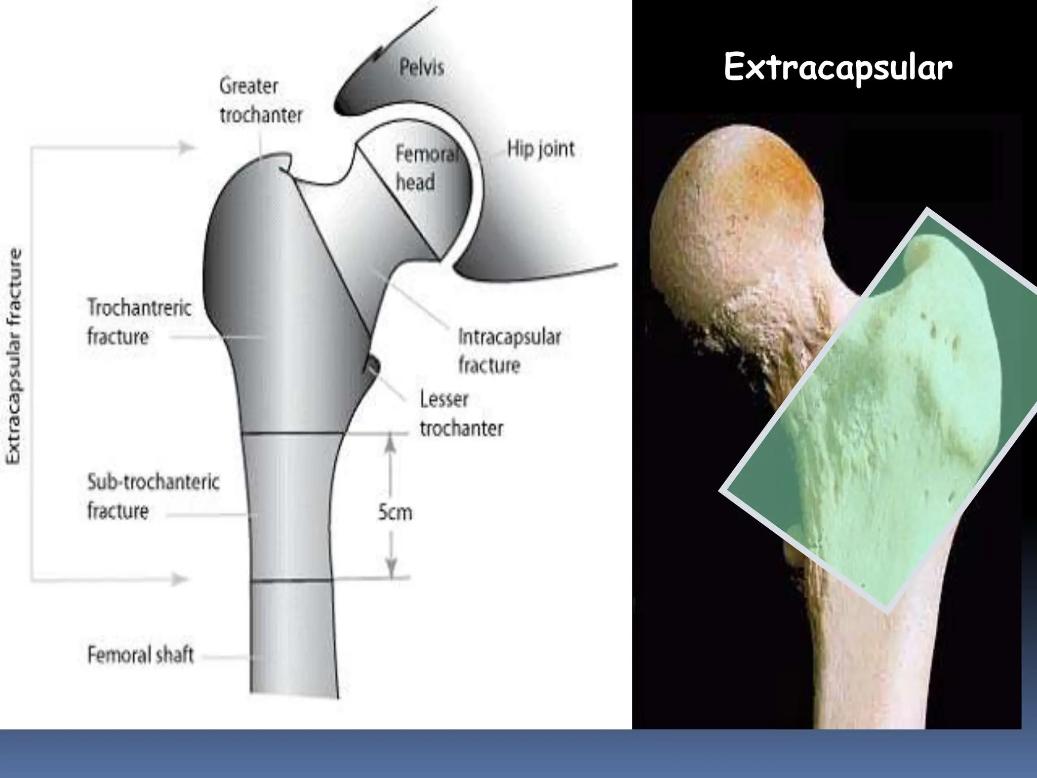trochanteric fractures.ppt. .. .. | PPT