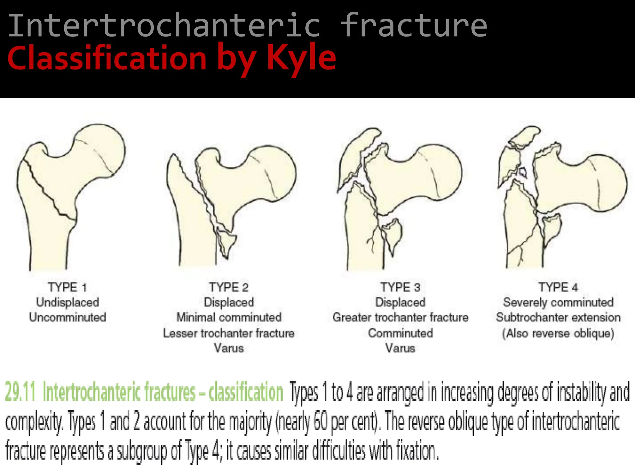 trochanteric fractures.ppt. .. .. | PPT