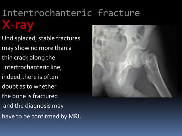 trochanteric fractures.ppt. .. .. | PPT