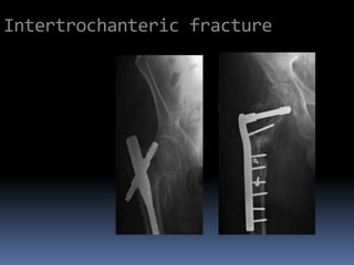 trochanteric fractures.ppt. .. .. | PPT