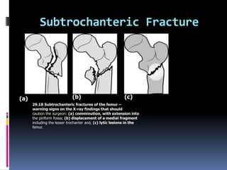 trochanteric fractures.ppt. .. .. | PPT