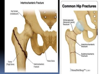 trochanteric fractures.ppt. .. .. | PPT