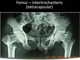 trochanteric fractures.ppt. .. .. | PPT