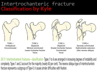 trochanteric fractures.ppt. .. .. | PPT