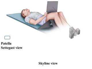 Trochlear dysplasia | PPTX