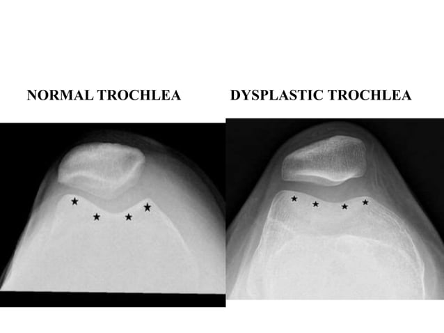 Trochlear dysplasia | PPTX | Death, Injury, or Military Conflict ...