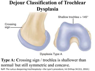 Trochlear dysplasia | PPTX