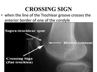 Trochlear dysplasia | PPTX