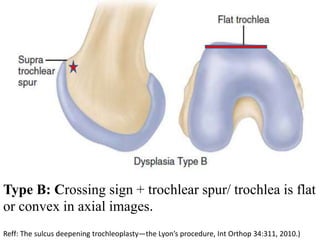 Trochlear dysplasia | PPTX