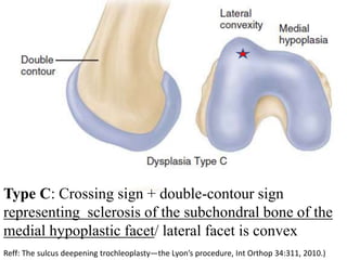 Trochlear dysplasia | PPTX