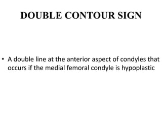 Trochlear dysplasia | PPTX