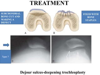 Trochlear dysplasia | PPTX