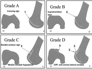 Trochlear dysplasia | PPTX
