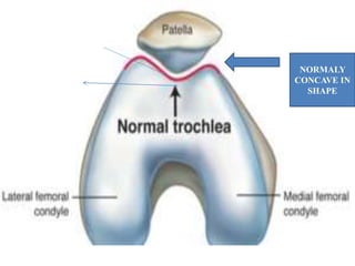 Trochlear dysplasia | PPTX
