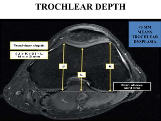 Trochlear dysplasia | PPT