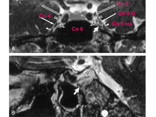 Trochlear Nerve Mri