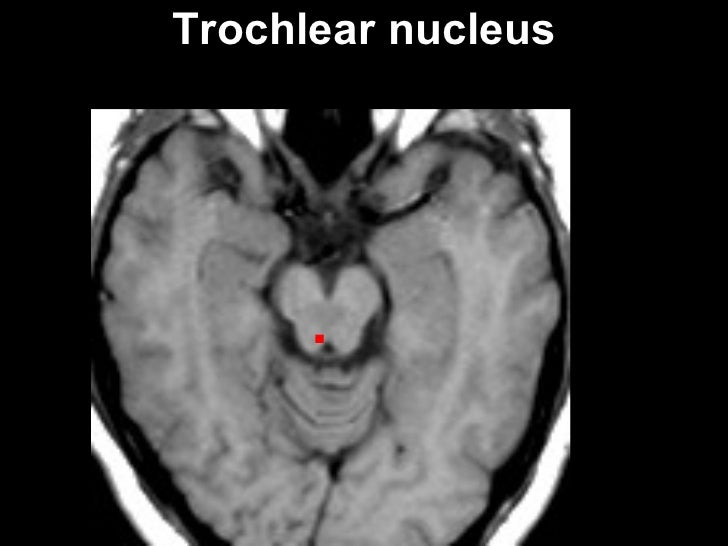 Trochlear nerve