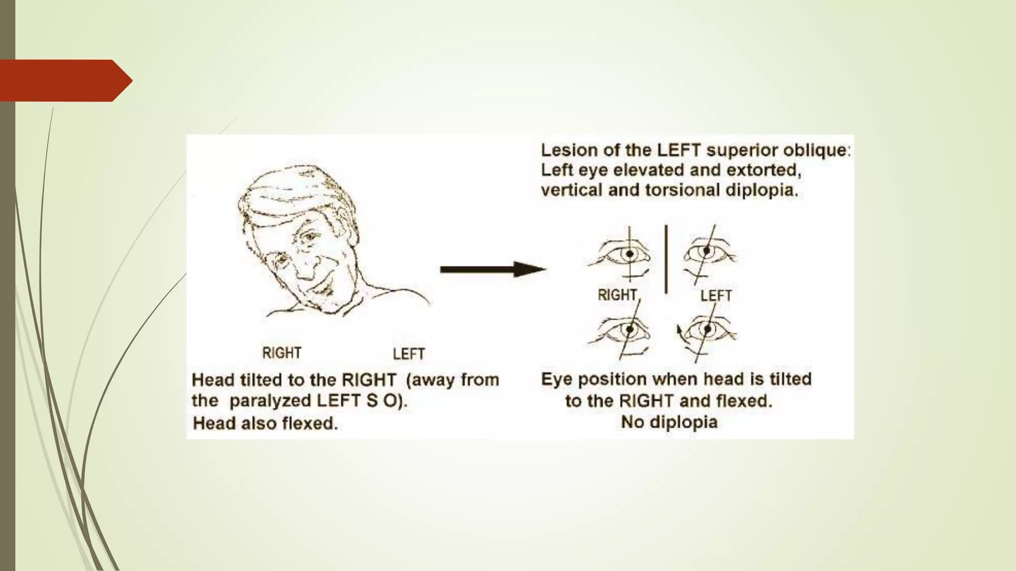 Trochlear nerve | PPT
