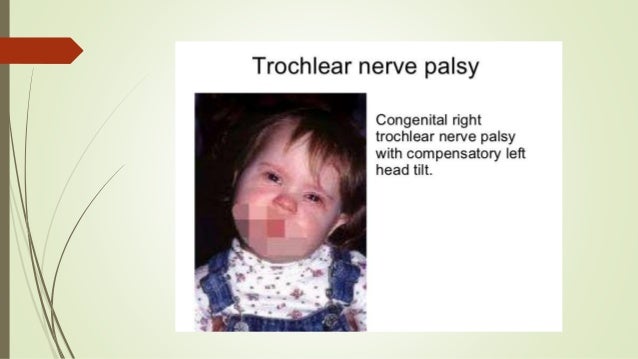 Trochlear nerve