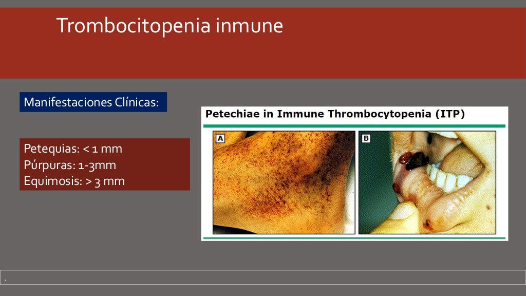 Trombocitopenia inmune Trombocitopenia inmune