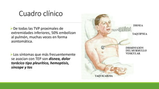 Tromboembolia pulmonar (TEP) | PPTX