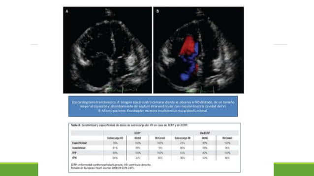 Tromboembolia pulmonar (TEP) | PPTX