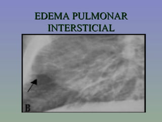 Imágenes radiográficas en la tromboembolia y el edema pulmonar | PPT