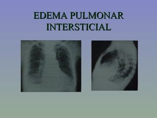 Imágenes radiográficas en la tromboembolia y el edema pulmonar | PPT