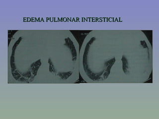 Imágenes radiográficas en la tromboembolia y el edema pulmonar | PPT