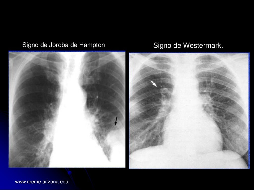 Tromboembolia pulmonar