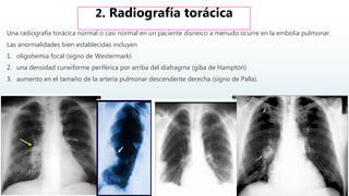 Tromboembolia pulmonar | PPTX