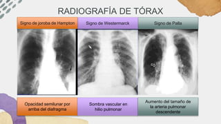 Tromboembolia pulmonar .pptx