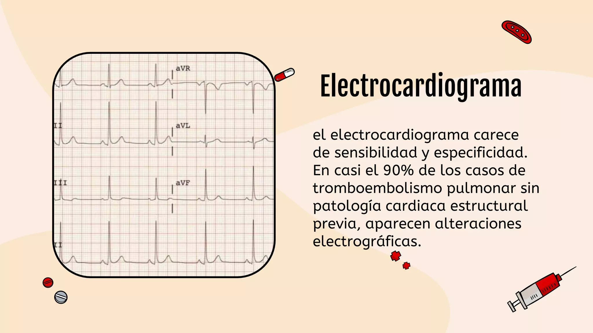 tromboembolia pulmonar.pptx